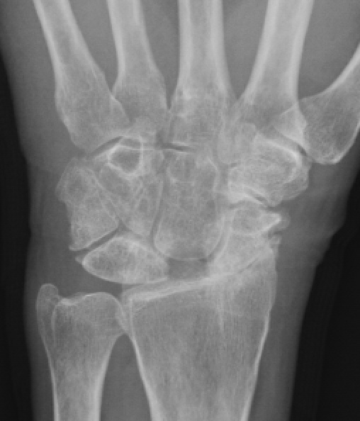 Arthritis Post Traumatic Arthritis Hand Surgery Wrist Surgery Elbow Surgery Arthritis Post Traumatic Arthritis Hand Surgery Wrist Surgery Elbow Surgery
